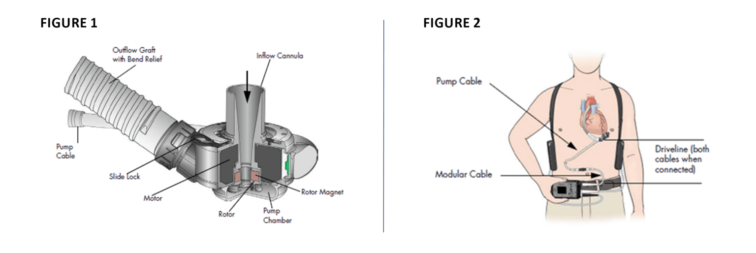 LVAD - Cadrenal Therapeutics, Inc.